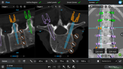 Spine Guidance 5 Software with Copilot | Stryker